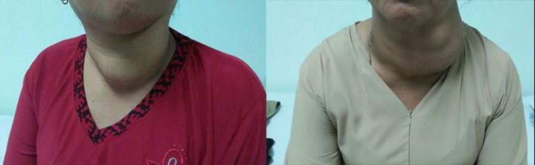 Tumor pada Gondok (Mengenal Struma, Bagian 3)